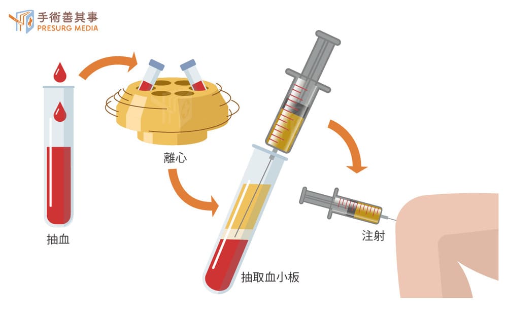 退化性關節炎如何治療：玻尿酸與PRP該如何選擇，優缺點、QA一次整理給你